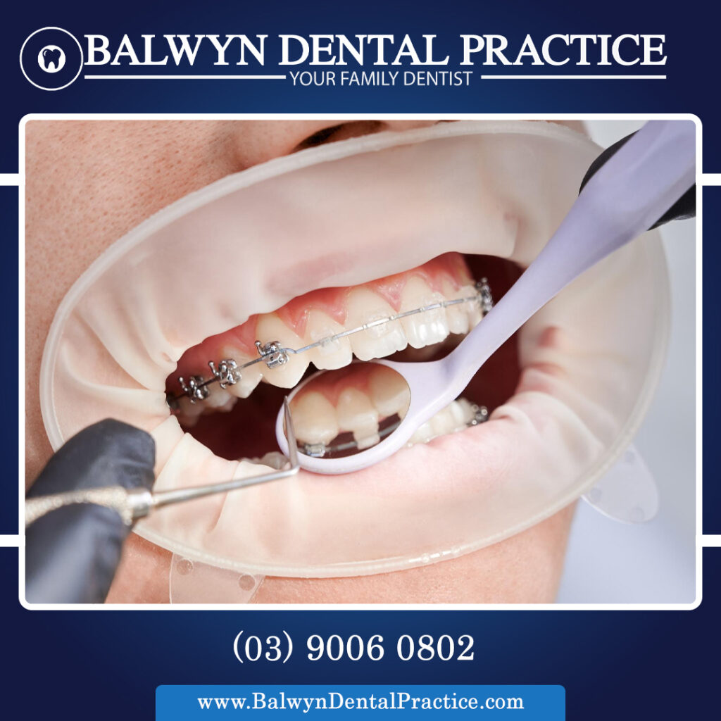 Fixing Teeth Gaps - Balwyn Dental Practice