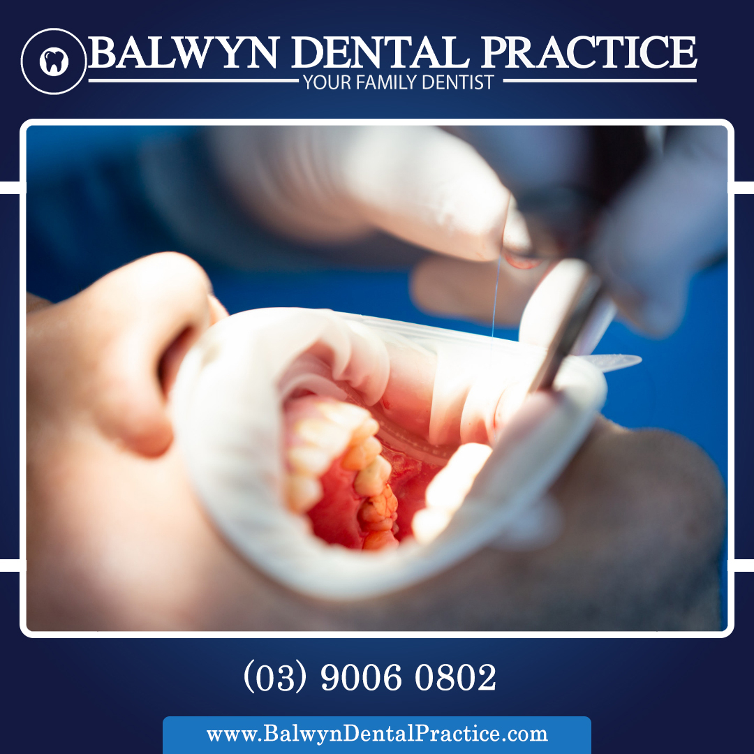 dental Scaling & Cleaning - Balwyn Dental Practice